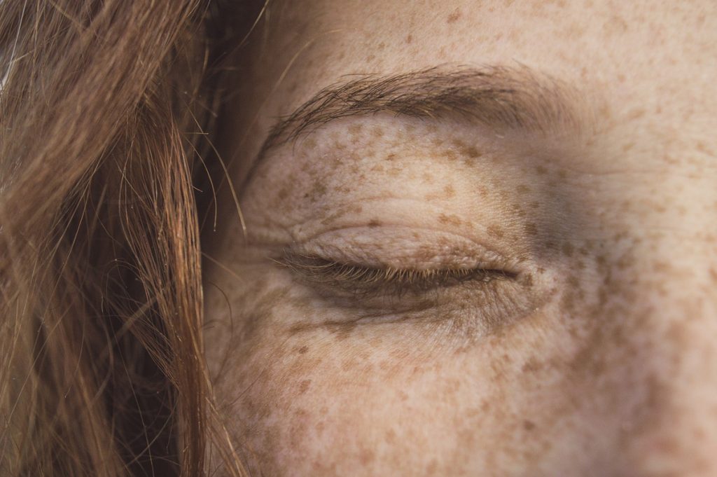 Freckles - What to Do About Them - Pioneerthinking.com